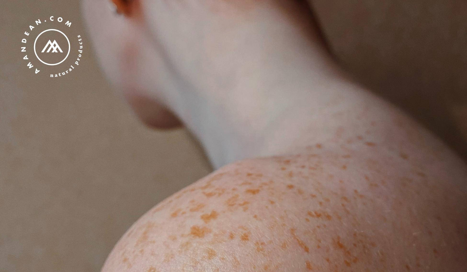 Causes of Hyperpigmentation: Drugs, Deficiencies, Diet & More - Amandean